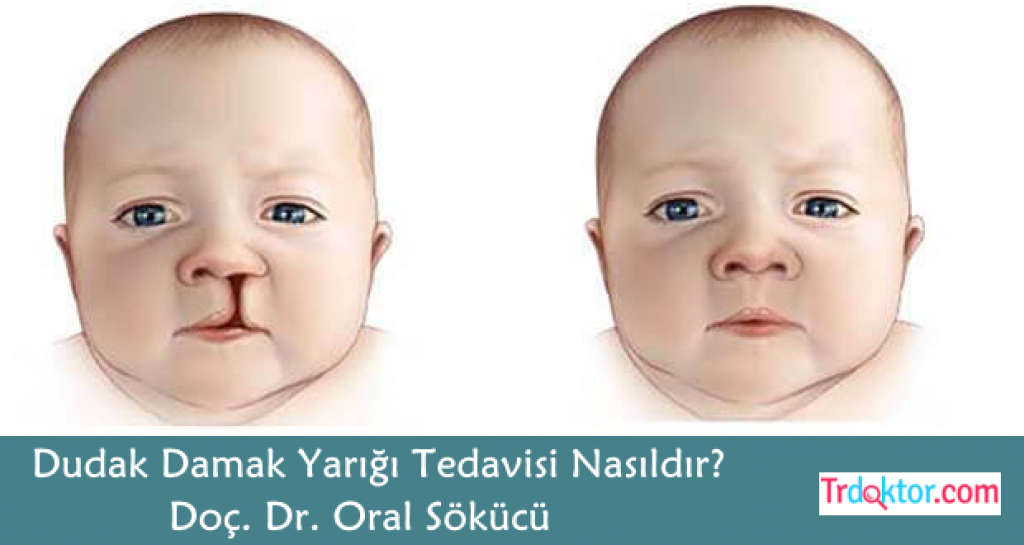 Dudak Damak Yarığı Tedavisi Nasıldır? -Makale-Doktor Ara , Soru Sor ...