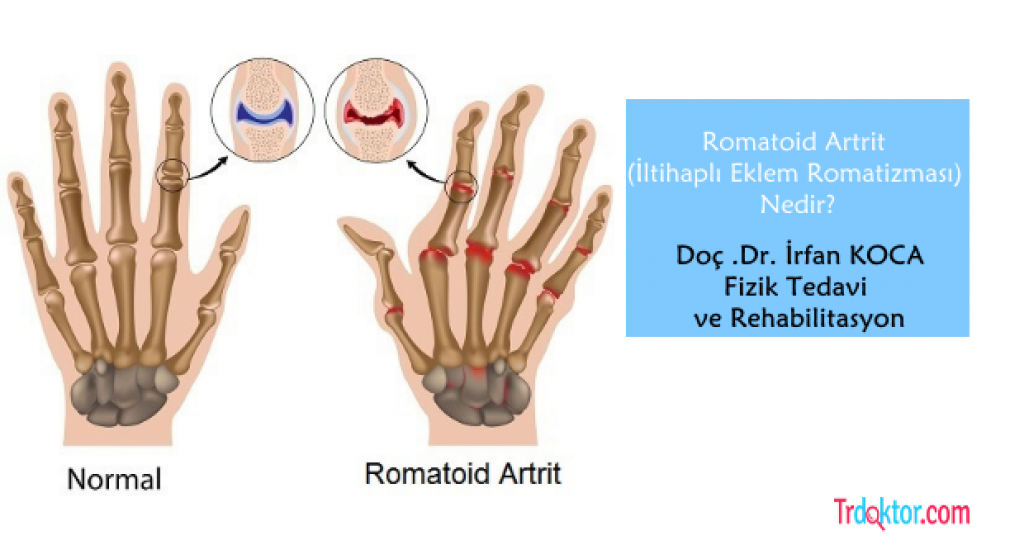 Romatoid Artrit (İltihaplı Eklem Romatizması) Nedir? -Makale-Doktor Ara ...